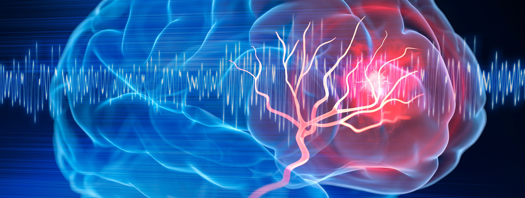 Study Shows High Prevalence of Hidden Brain Changes in People With ...